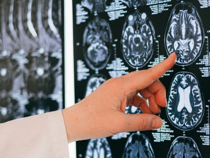 Budowa mózgu – podział kliniczny i szczegółowa budowa – Zdrowie Wprost