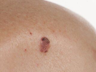 Rak skóry – jak wygląda? Poznaj jego rodzaje, przyczyny powstawania i ...