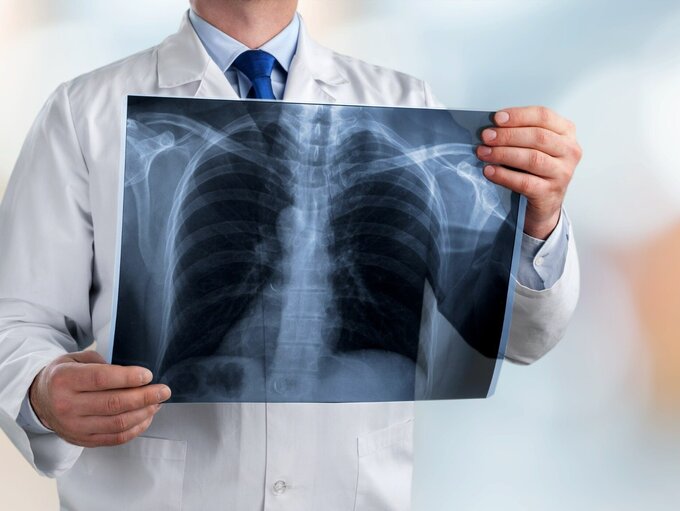 Rak płuca. Nowoczesna terapia – immunoterapia stosowana – NewsMed.pl