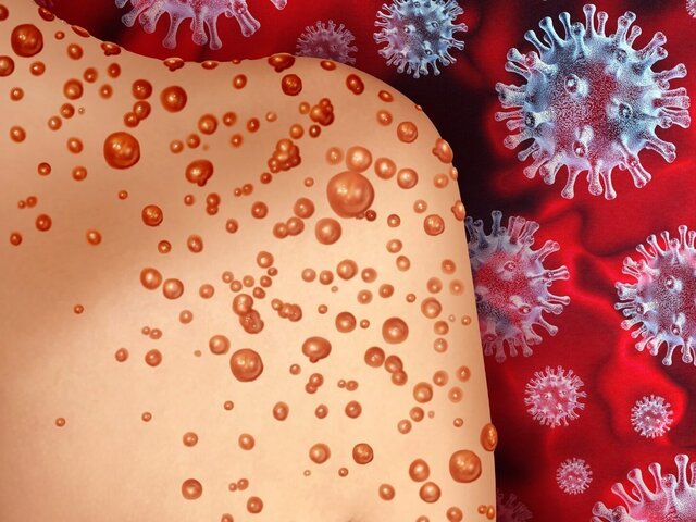 Groźne powikłanie po małpiej ospie. Pacjent zgłosił się do lekarza z ...