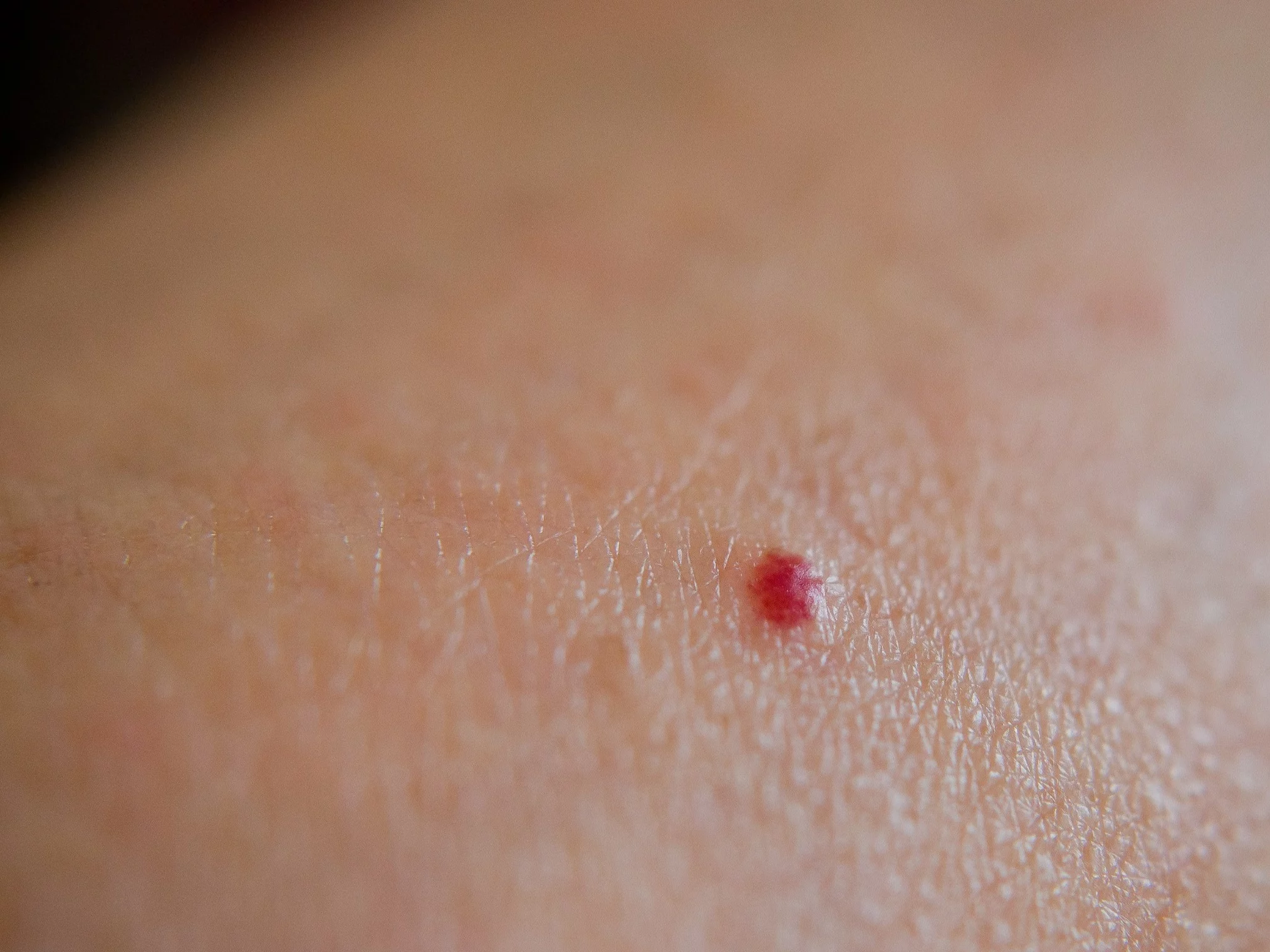 Rubinki mogą być objawem poważnej choroby. Czym są naczyniaki rubinowe ...